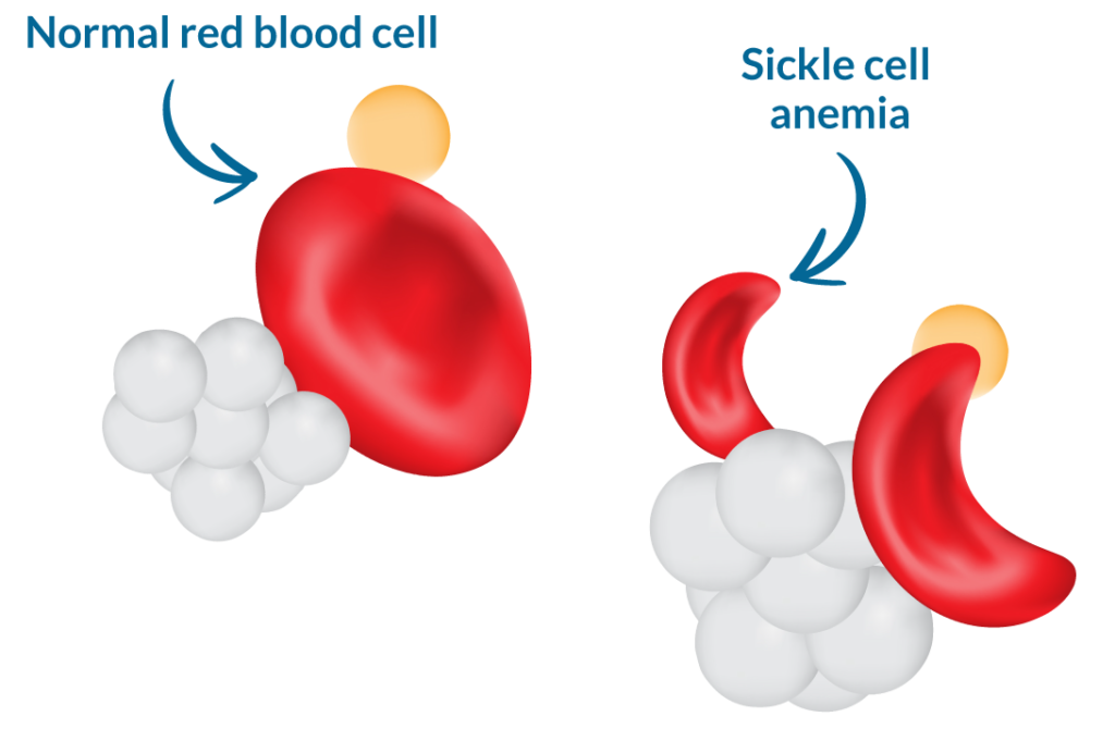 Understanding Sickle Cell Anemia: Causes, Symptoms, Treatment, and ...